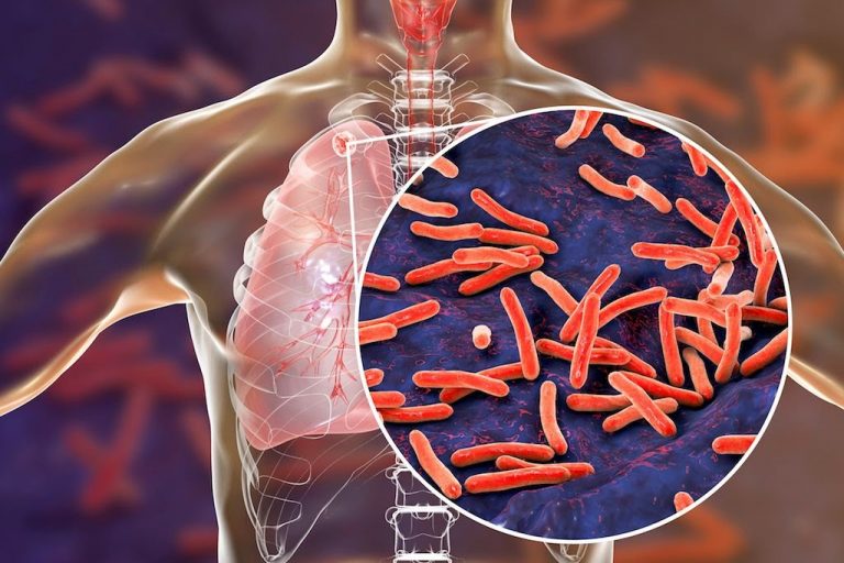 Mycobacterium tuberculosis – Platform | CME
