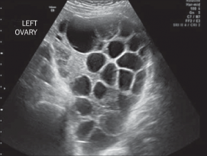 All over Discussion about Ovarian Cyst – Platform | CME