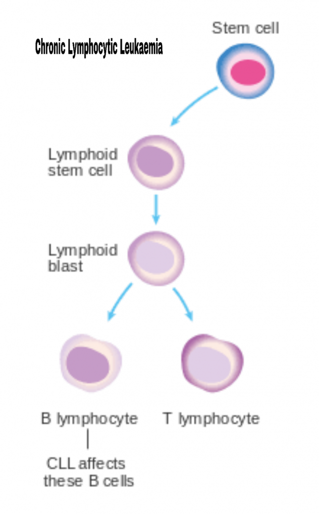 Why Chronic Lymphocytic Leukaemia Is Different From Other Types of ...