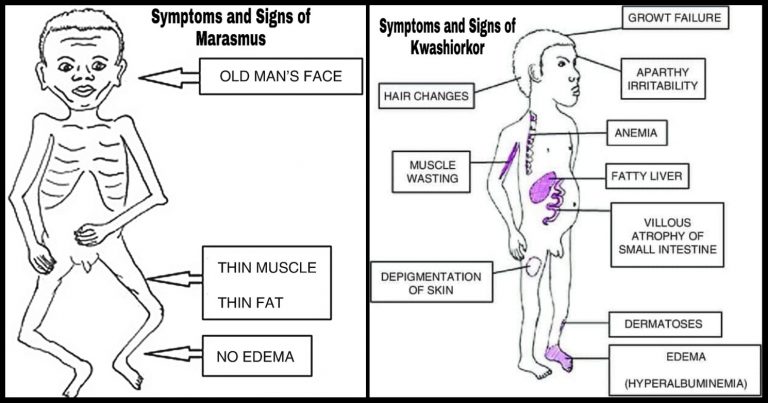 How Starvation Causes Death – Platform | CME