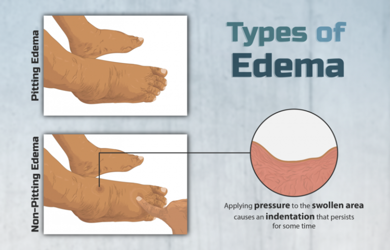 তিন বন্ধুর “Edema” চর্চা – Platform | CME