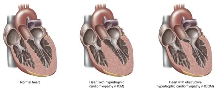 Introducing Third & Fourth Heart Sounds – Platform | CME