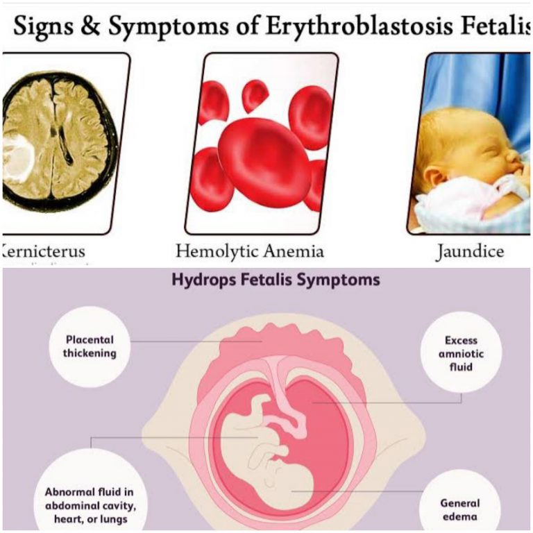 All about Hydrops Fetalis & Erythroblastosis Fetalis – Platform | CME
