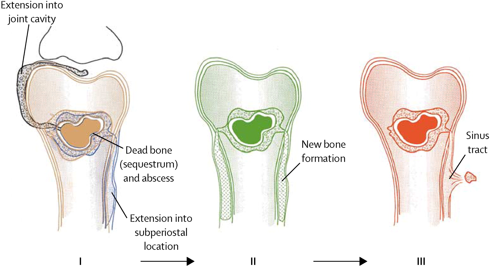 Some Discussion About Osteomyelitis – Platform | CME