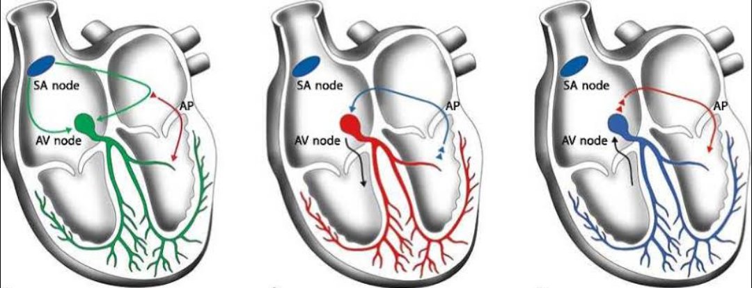 Wolff Parkinson White (WPW) Syndrome: Tale of Extra Electrical Pathway ...