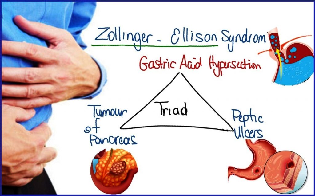 Clinical Case| Zollinger Ellison Syndrome|(Part-2) – Platform | CME