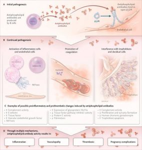 Let’s Learn About Lupus & Anti Phospholipid Antibody Syndrome ...