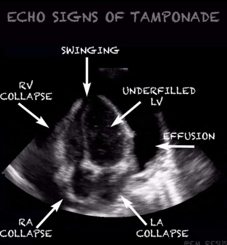 Do you know about Cardiac Tamponade?? – Platform | CME