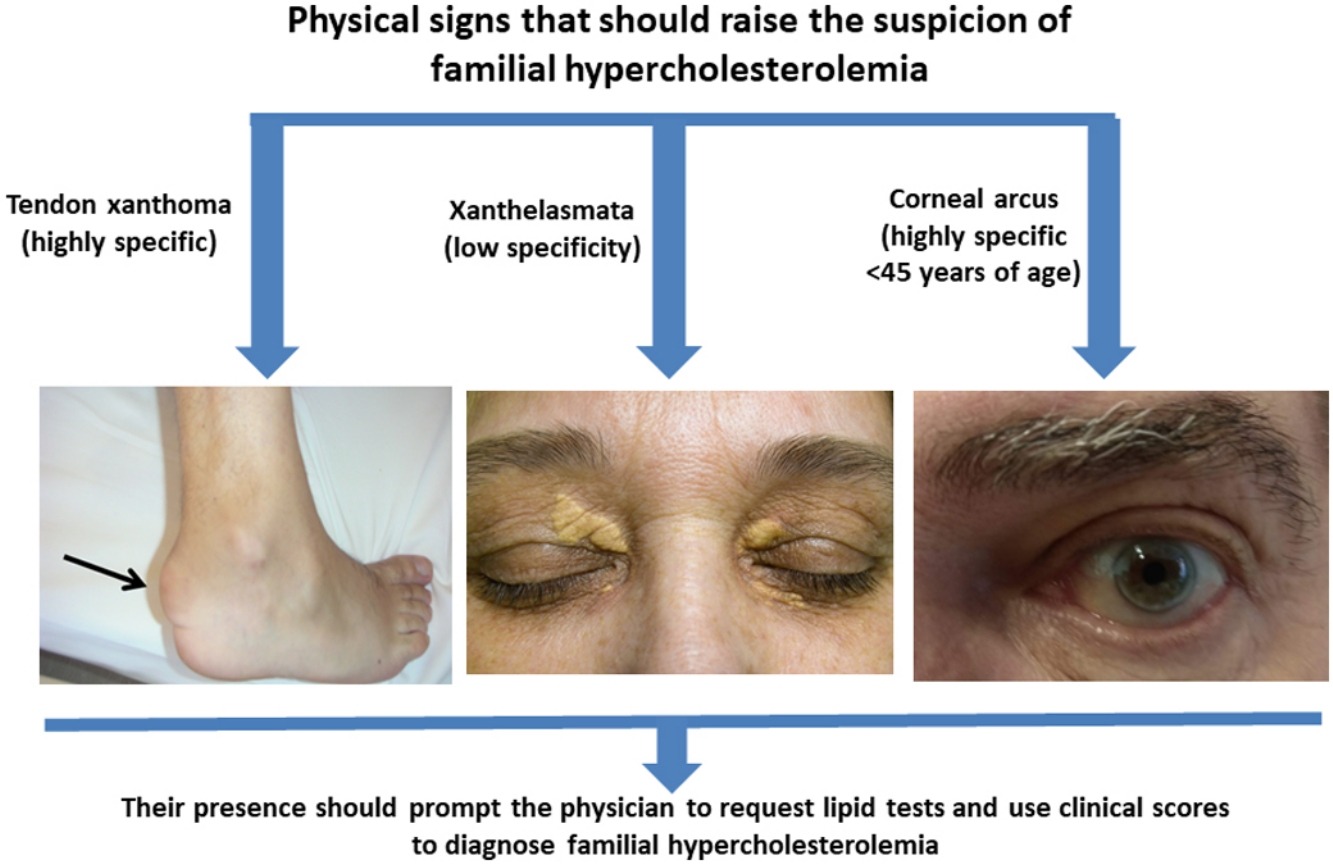 A Discussion about Xanthelasma – Platform | CME