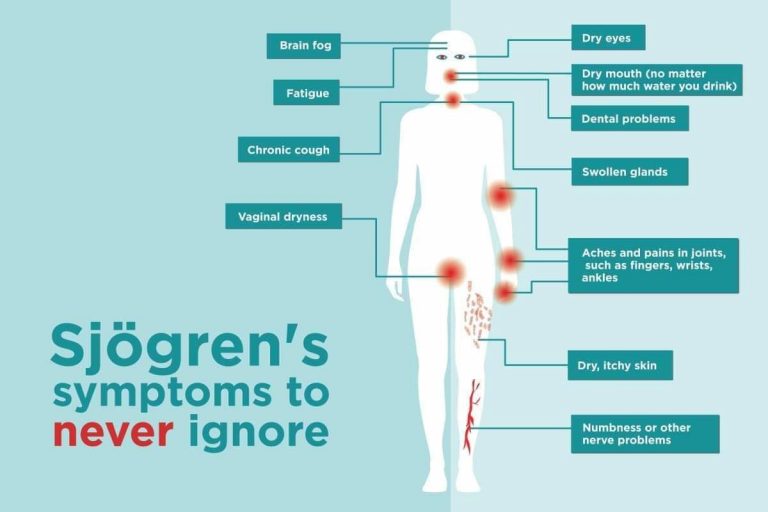 Let’s Know About Primary & Secondary Sjogren Syndrome – Platform | CME
