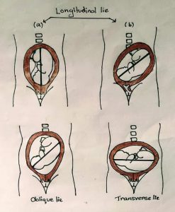 Different Positions of Uterus during Pregnancy – Platform | CME